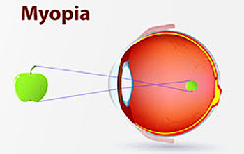 Myopie-Management | Ihr Optiker in Landshut